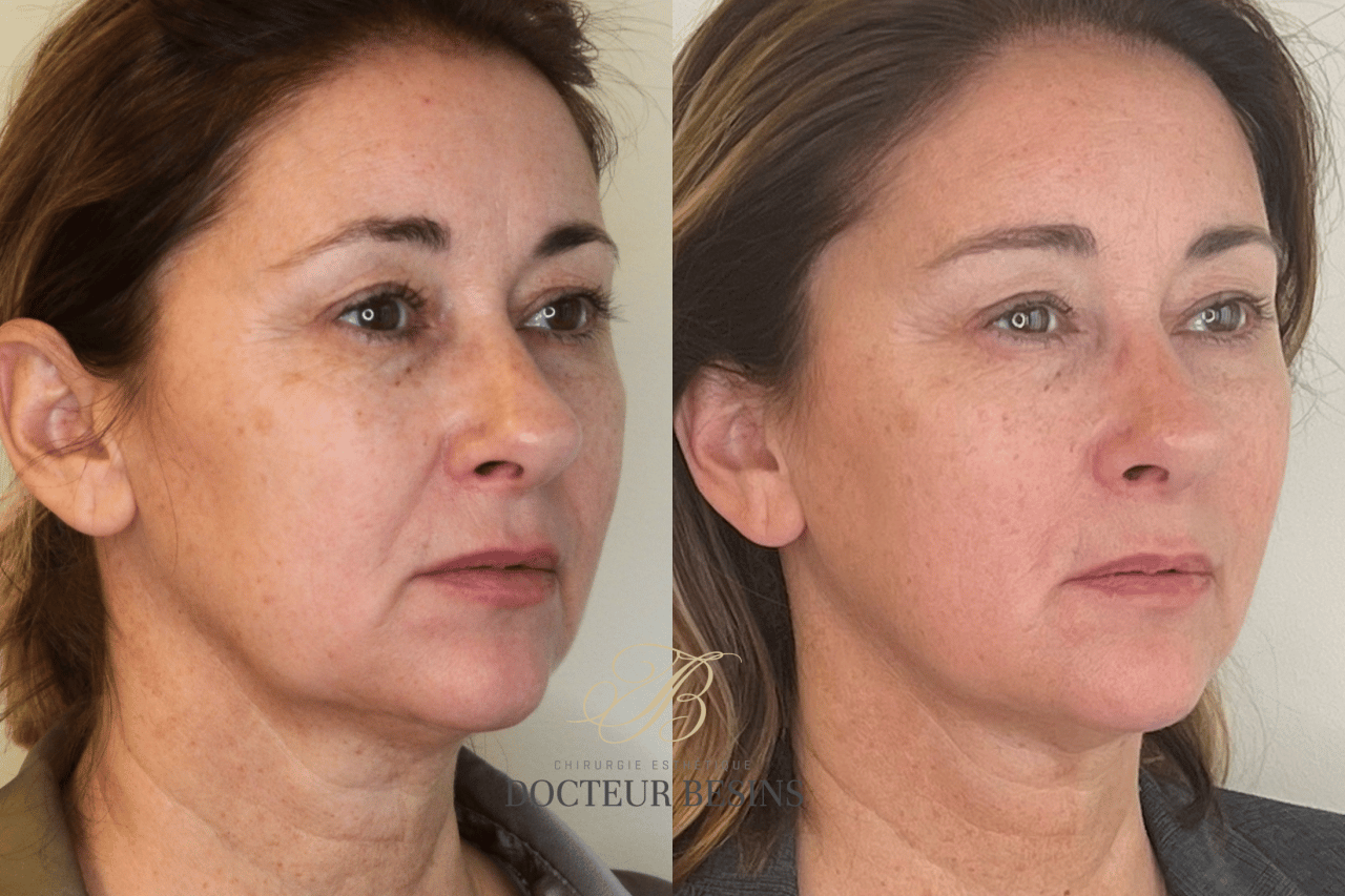 Les fils tenseurs à Nice - Docteur Thierry Besins