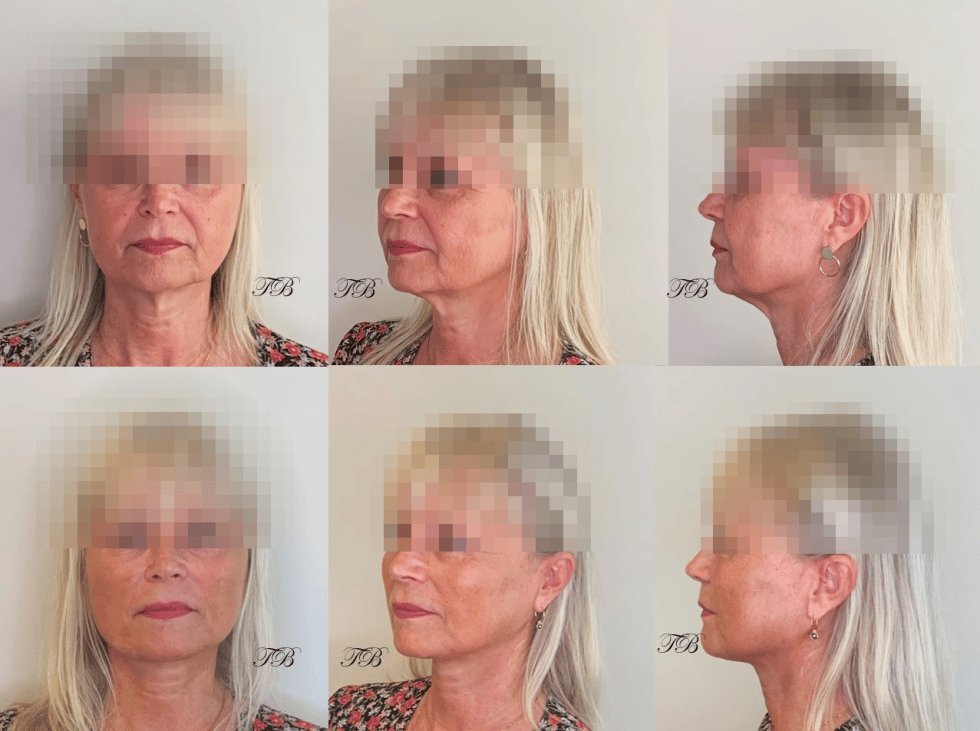 Facial thread lifts by Doctor Thierry Besins - Nice